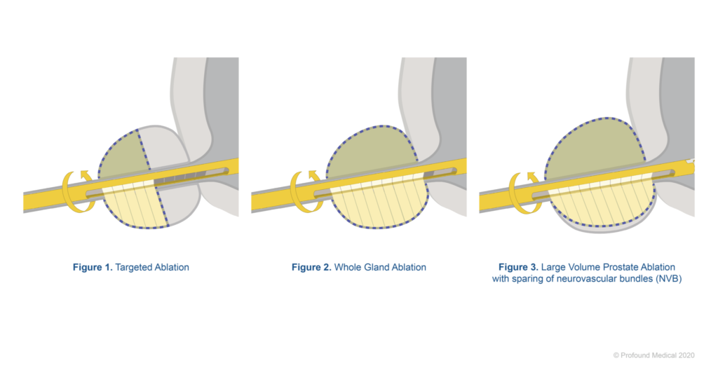 The TULSA Procedure is Customizable for you | TULSA Procedure